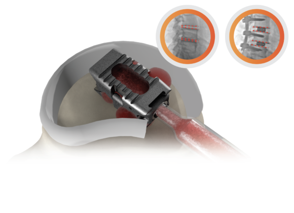 ProLift Micro-Invasive Expandable PLIF/TLIF Spacer System