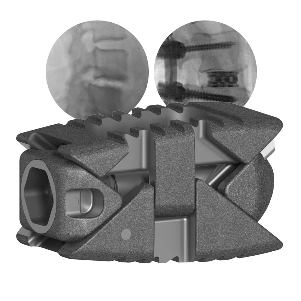 Micro Invasive Technology: Learn about the Life Spine Difference